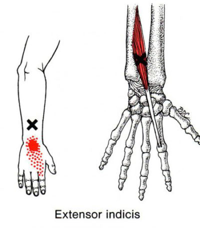 Wrist Pain - Forearm Overload... - West Suburban Pain Relief