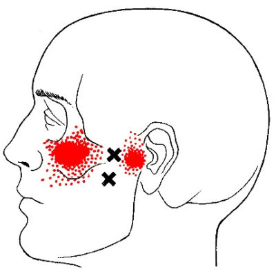 TMJ Headache - Myofascial Pain - TriggerPoint West Suburban Pain Relief