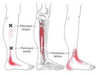 Heel and Ankle Pain - The Fibularis Muscles - West Suburban Pain Relief
