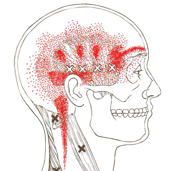 Chronic Headache Pain - Myofascial Therapy - West Suburban Pain Relief