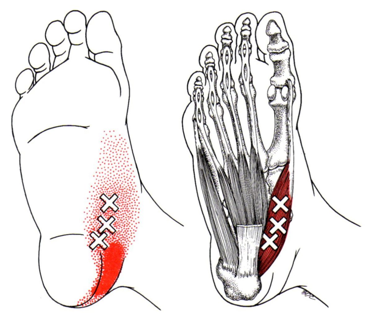 Foot pain? Intrinsic muscles trigger points? Try West Suburban Pain Relief!