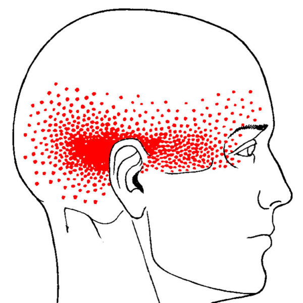 Chronic Tension Headache - TriggerPoint? West Suburban Pain Relief