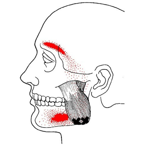 TMJ Headache - Myofascial Pain - TriggerPoint West Suburban Pain Relief
