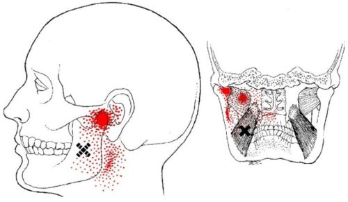 TMJ Headache - Myofascial Pain - TriggerPoint West Suburban Pain Relief