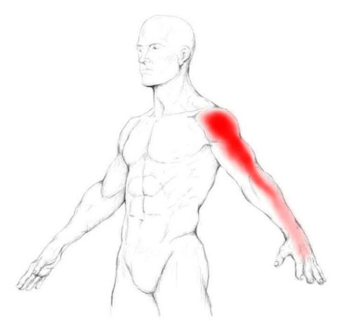 Infraspinatus Muscle - Shoulder to Hand Pain - West Suburban Pain Relief