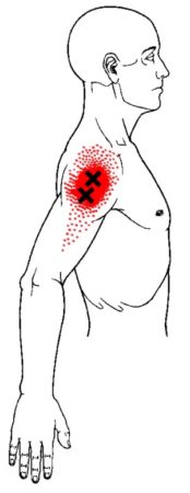 Deltoid Muscles - Deep Shoulder Pain - West Suburban Pain Relief