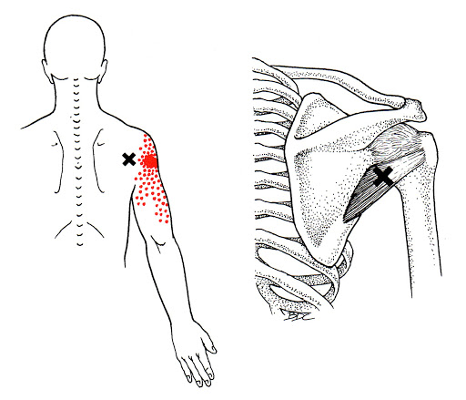Teres Minor Muscle - Back of Shoulder Pain - West Suburban Pain Relief
