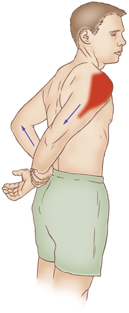 Coracobrachialis - Front Shoulder/Back Arm Pain - West Suburban Pain Relief