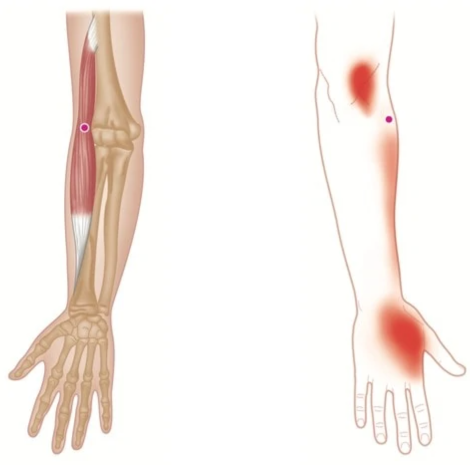 Brachioradialis - Hand and Forearm Pain - West Suburban Pain Relief